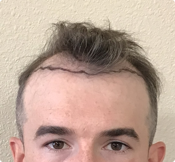 White/Caucasian-Male-26 - 30-old-2001 - 2500-grafts-hair-restoration