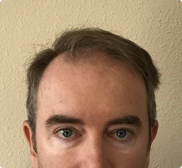 White/Caucasian-Male-46 - 50-old-2501 - 3000-grafts-hair-restoration