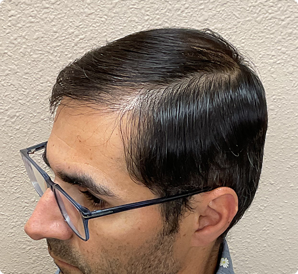 White/Caucasian-Male-41 - 45-old-3001 - 3500-grafts-hair-restoration