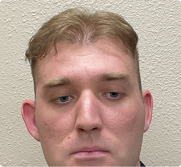 White/Caucasian-Male-18 - 25-old-2501 - 3000-grafts-hair-restoration