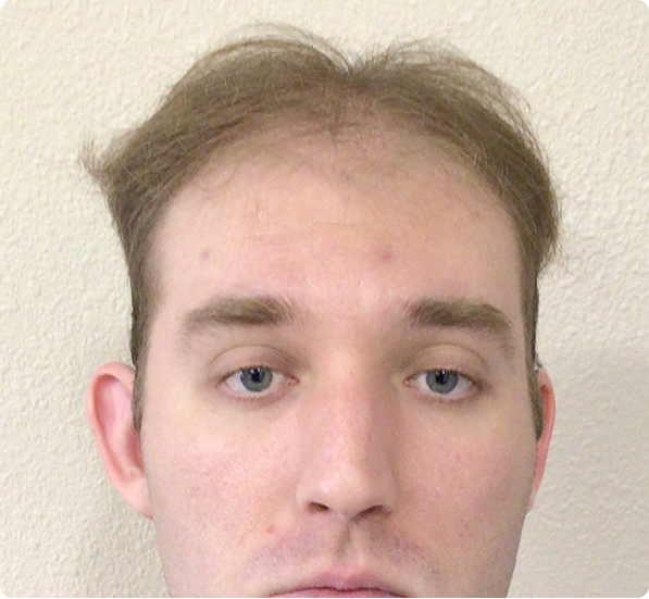 White/Caucasian-Male-18 - 25-old-2501 - 3000-grafts-hair-restoration
