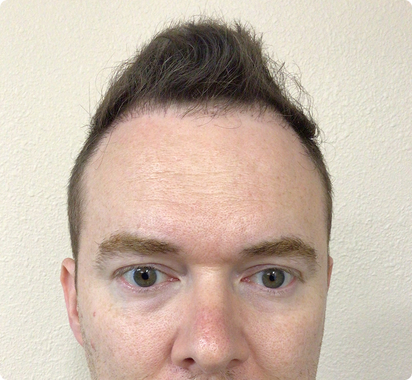 White/Caucasian-Male-31 - 35-old-2001 - 2500-grafts-hair-restoration